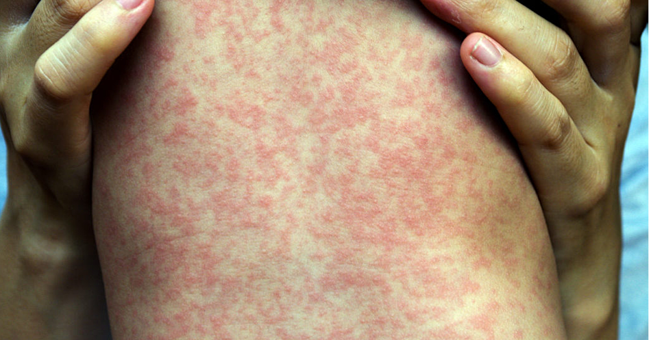 Samoa Observer | Sixteen suspected measle cases, Ministry awaits